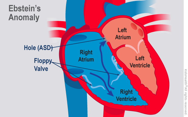 Ebstein Anomaly | Dayton Children's