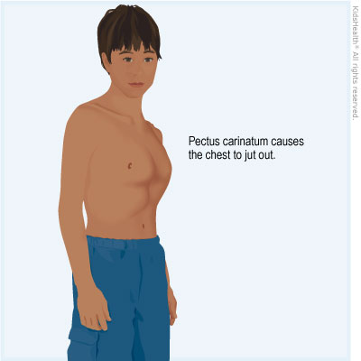 Chest Wall Disorder Pectus Carinatum Rady Children s Hospital