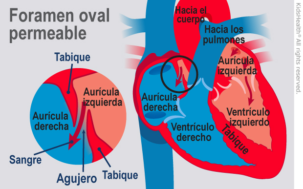 Foramen oval permeable (para Padres) - Nemours Kidshealth